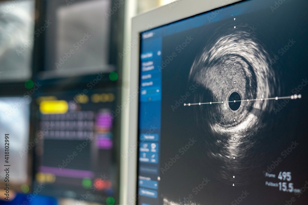Intravascular ultrasound imaging (IVUS) at cardiac catheterization ...