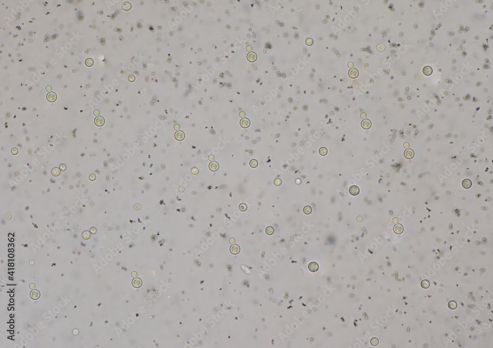 Cryptococcus neoformans is an encapsulated yeast India ink preparetion ...