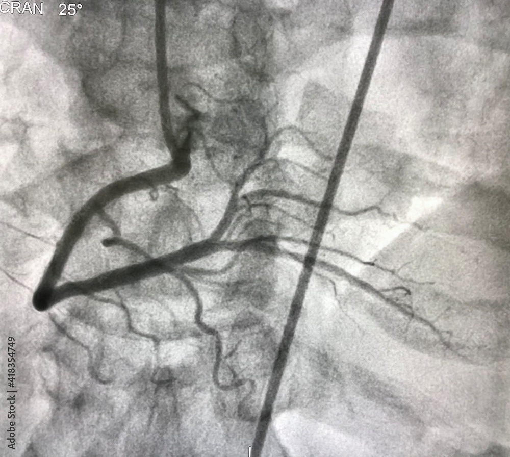 Normal coronary angiogram of right coronary artery (RCA) during cardiac ...
