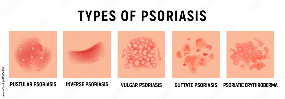Psoriasis rash vector skin hand infection background. Psoriasis ...