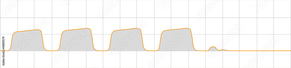 Arterial pulse Capnography Waveform monitoring during an apnea ...