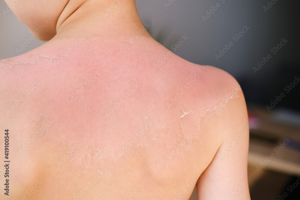 back of a child with sunburns and peeling dead skin of a 6-7 year old ...