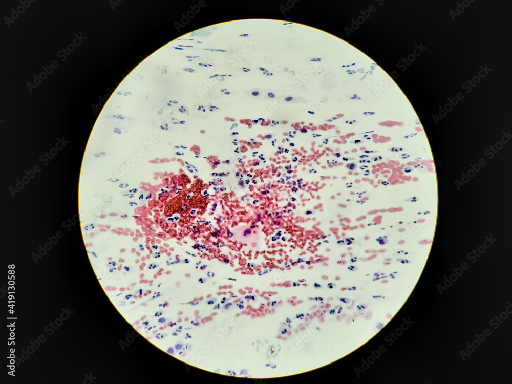 Abnormal squamous epithelial cells view in microscopy.HPV criteria for ...