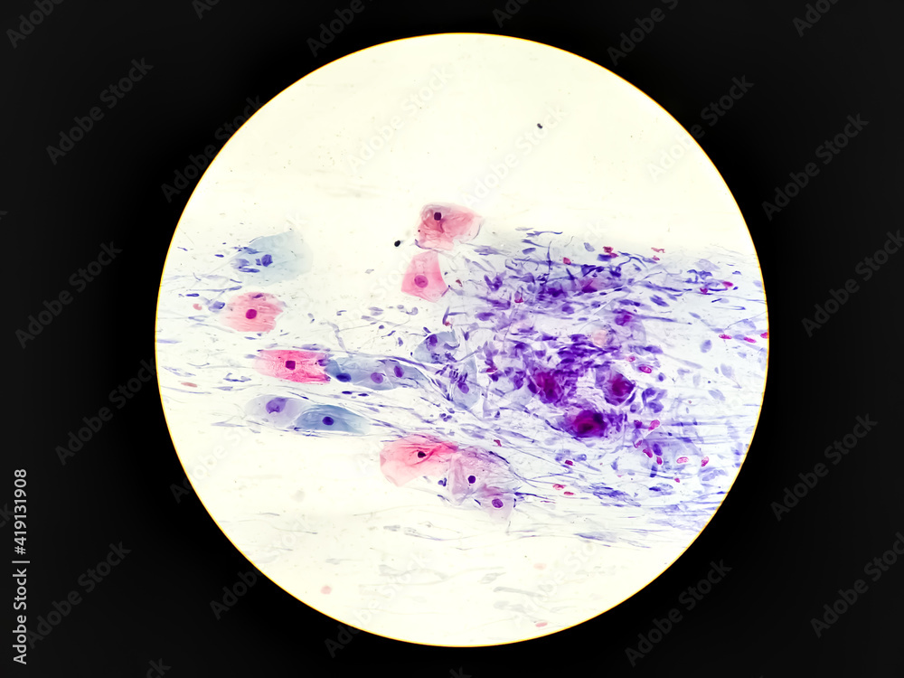 Normal squamous epithelial cells of cervical human view in microscopy ...