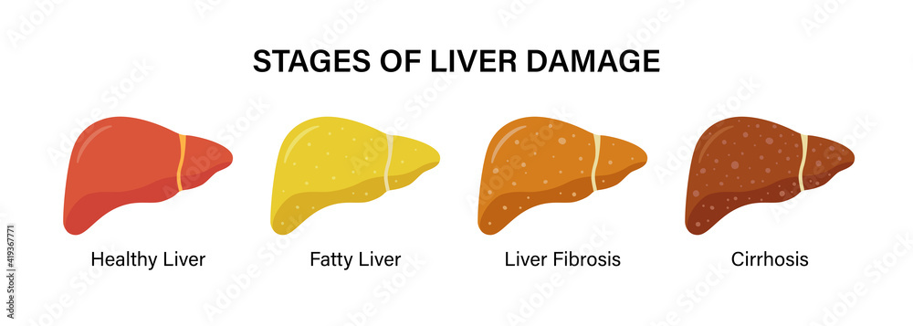 Stages of nonalcoholic liver damage. Healthy, fatty, fibrosis ...