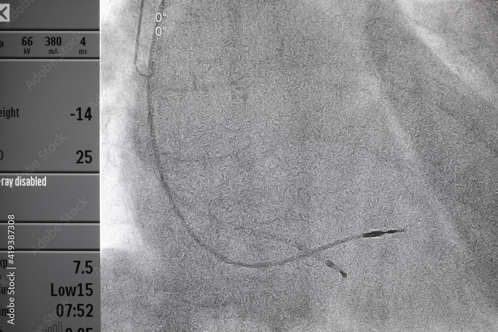Permanent pacemaker x-ray image in cardiac catheterization Stock Photo ...