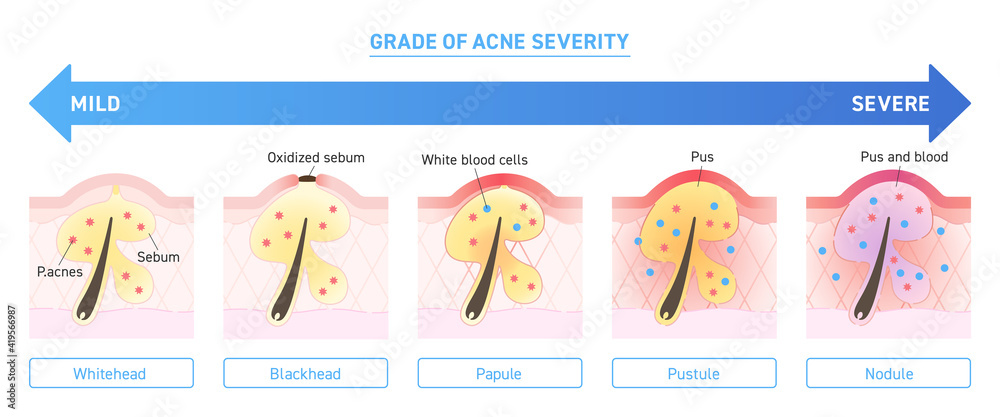 Grades Of Acne