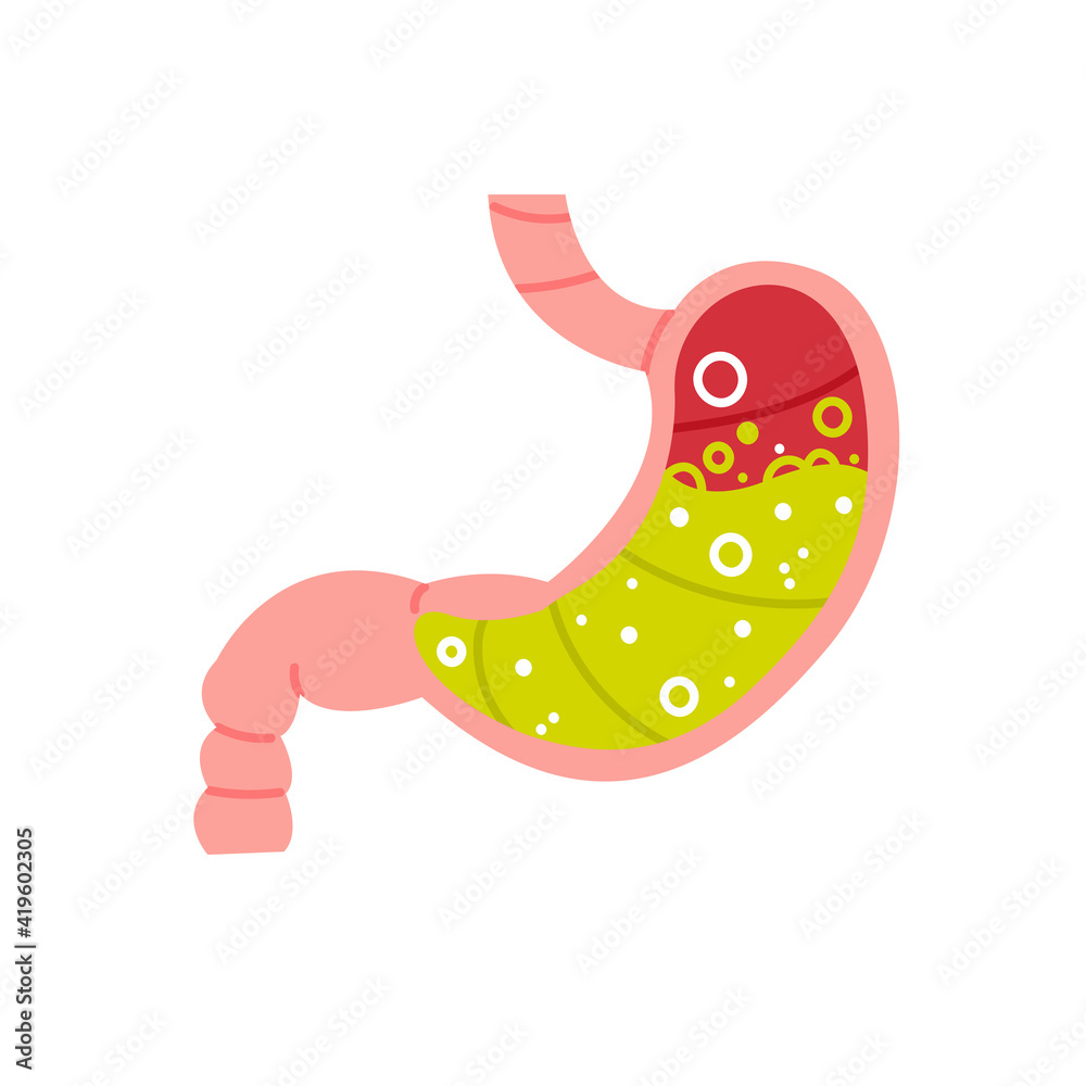 High unhealthy level of stomach acidity. Burn in belly flat cartoon ...