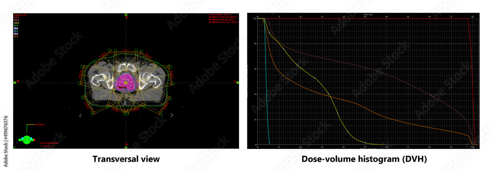 Prostate cancer Intensity-modulated technology radiotherapy (IMRT ...