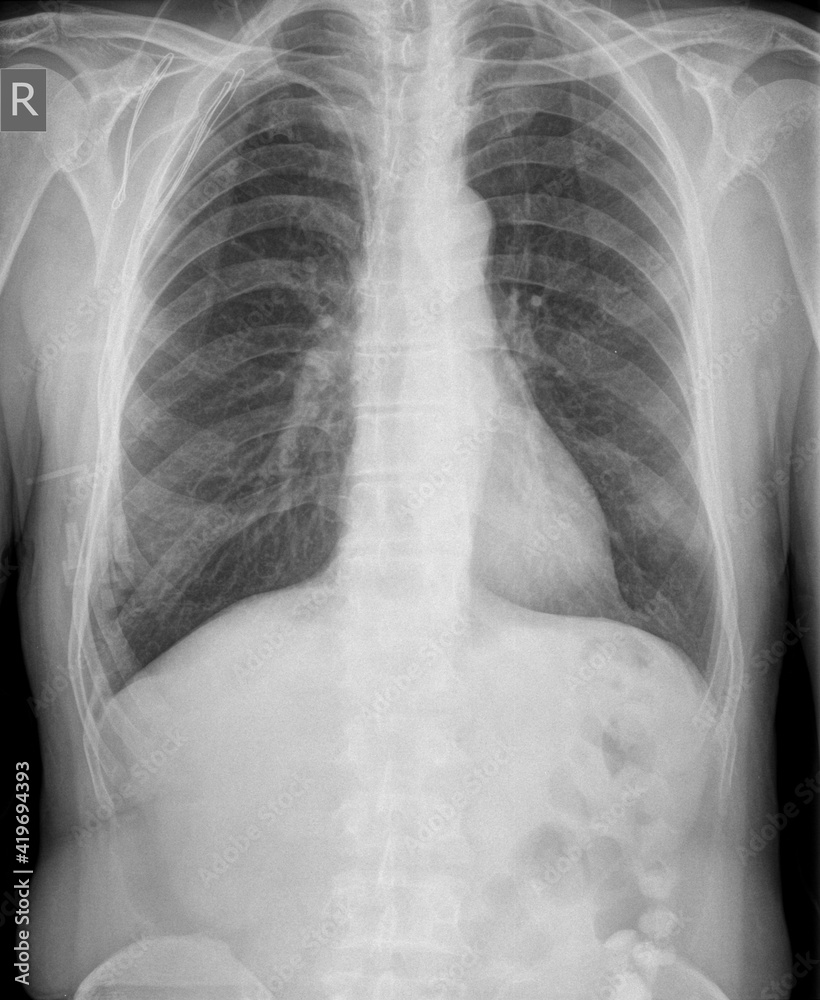 Chest xray images Stock Photo | Adobe Stock