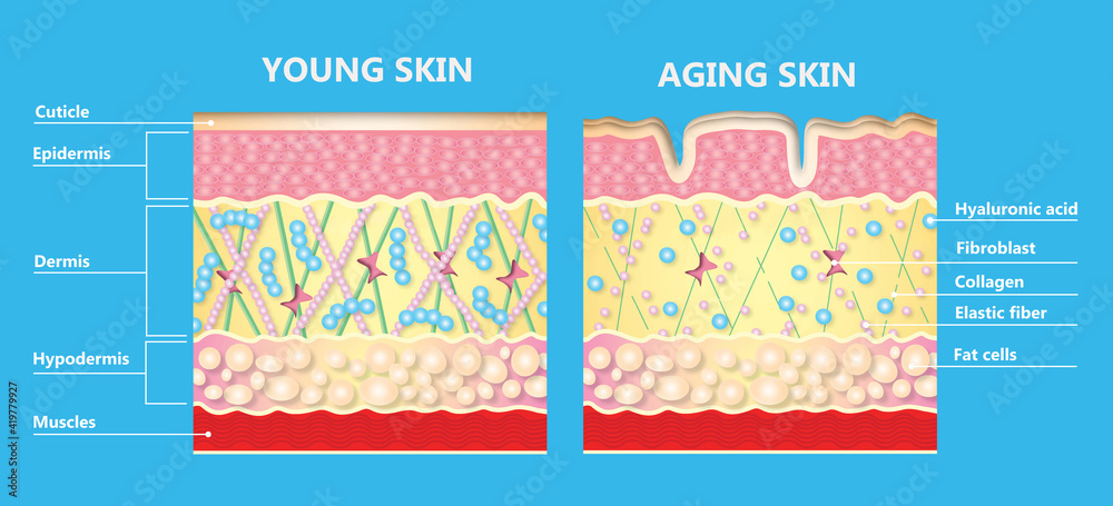 The diagram of younger skin and aging skin Stock Vector | Adobe Stock