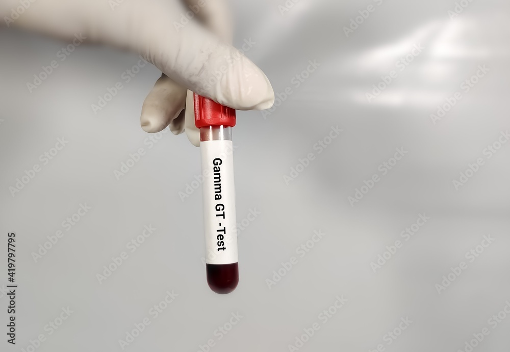 Test Tube with blood sample for Gamma GT test, Liver enzyme. A medical ...