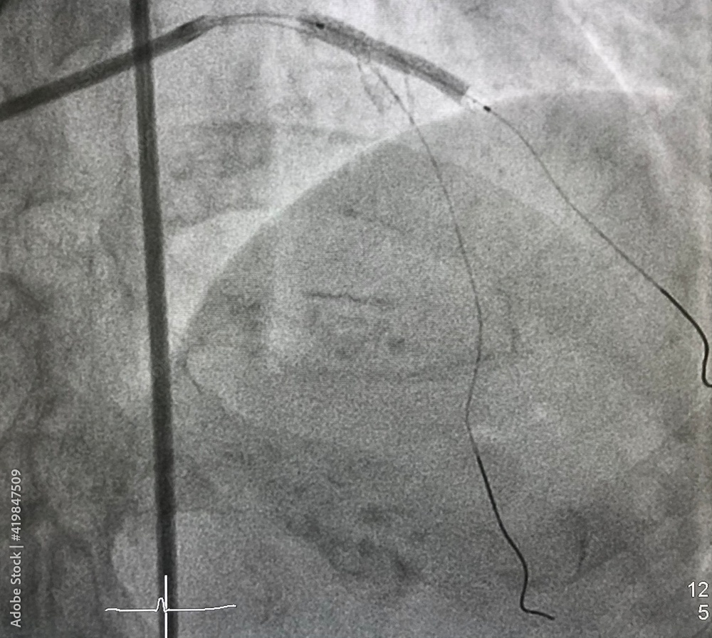 Drug eluting stent (DES) deployed at left anterior descending artery ...