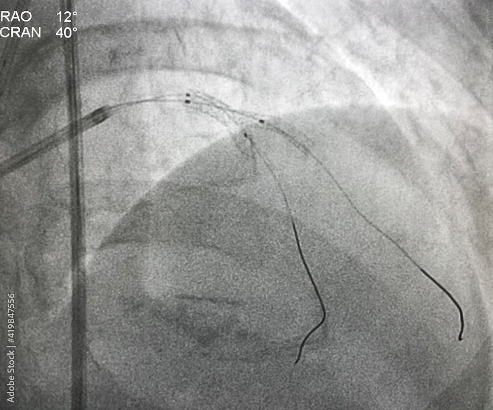 Two non-compliance balloons (NC balloon) inflated after coronary stent ...