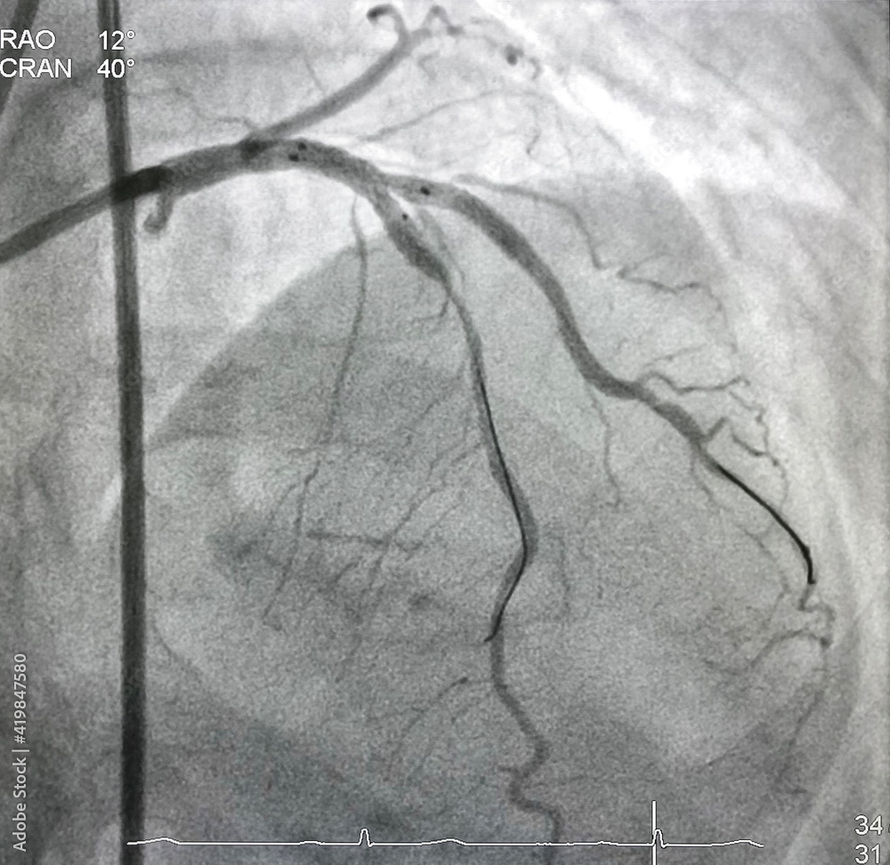 Two non-compliance balloons (NC balloon) inflated after coronary stent ...