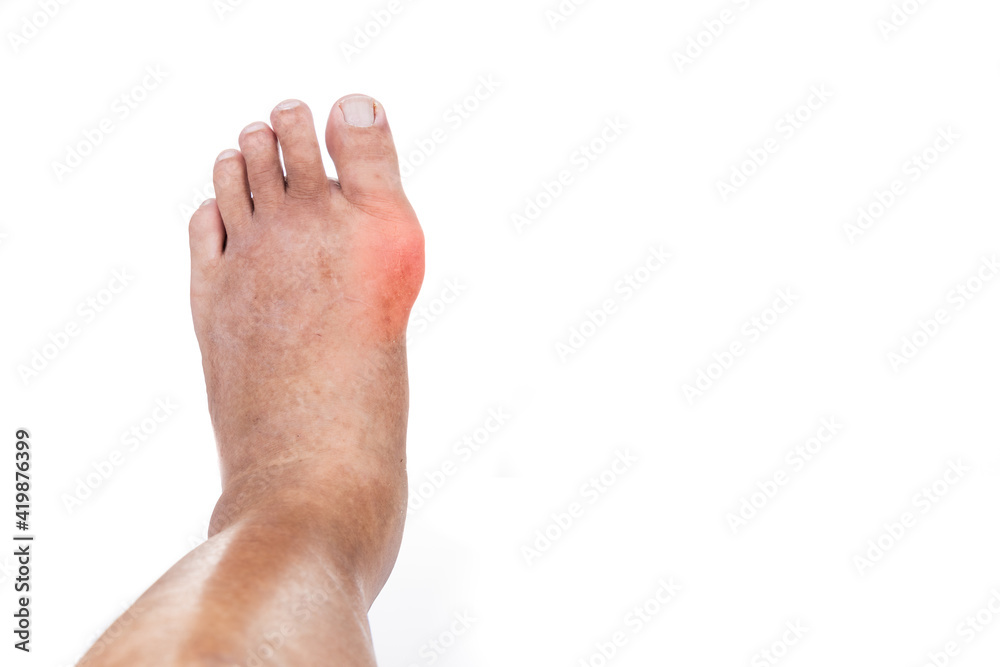 Swollen deformed inflammed toe joint with painful gout Stock Photo ...