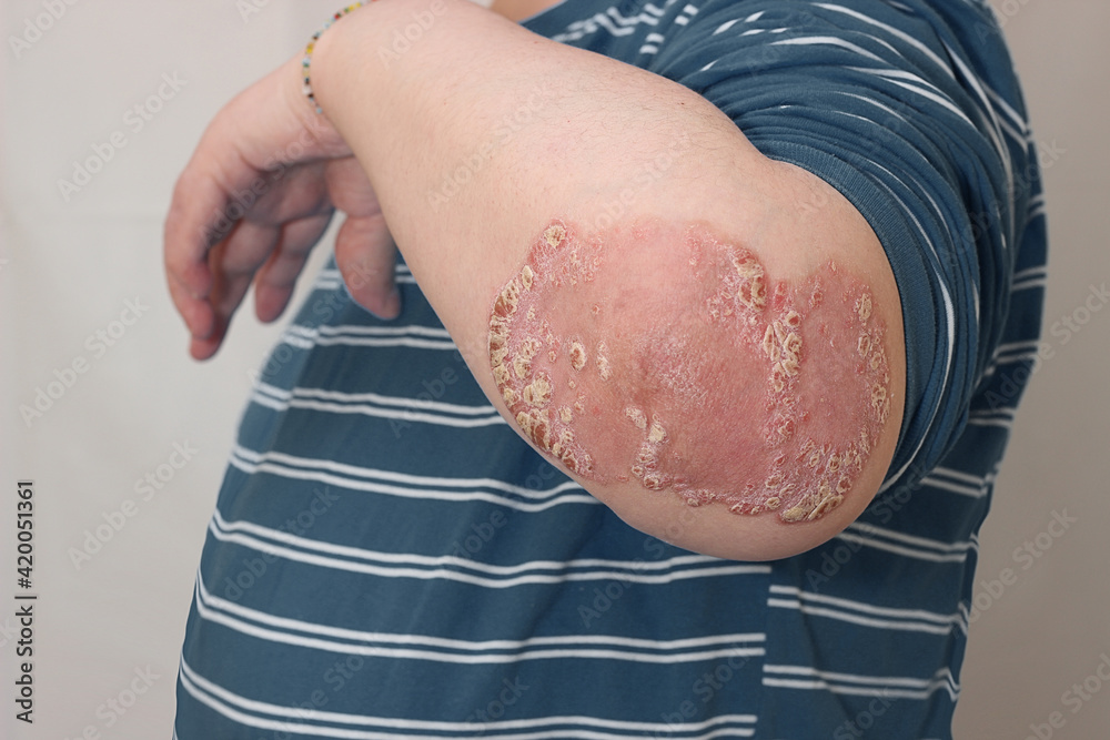 psoriasis on the skin of the elbow in a young woman in a green jacket ...