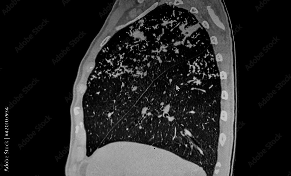 CAT Scan of patient with tuberculosis infection. Medical themes Stock ...