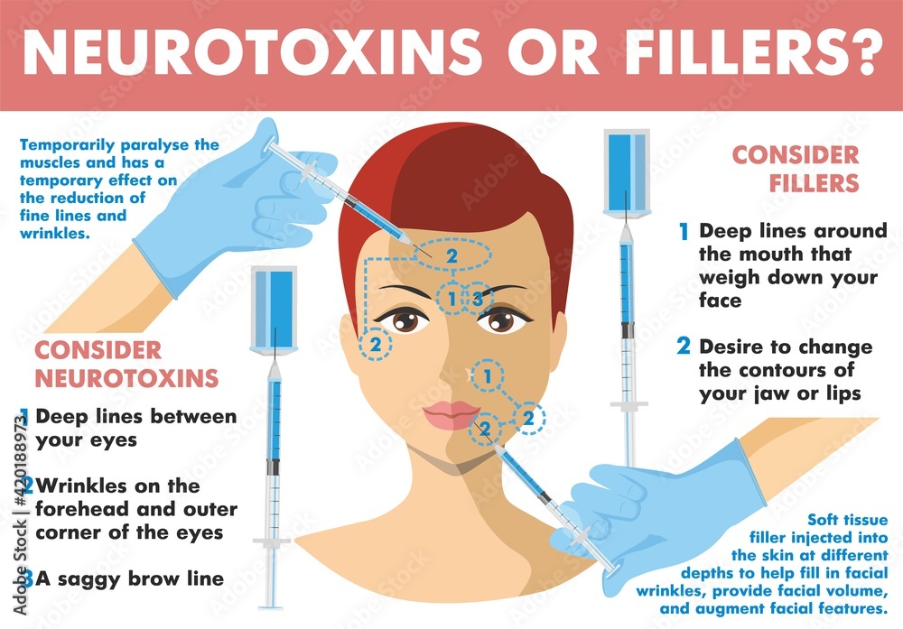 Neurotoxins Or Fillers Infographics Neurotoxin Injection Woman