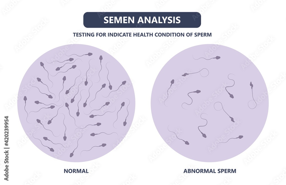 Vektorová grafika „in vitro fertilization IVF semen test sample sperm ...