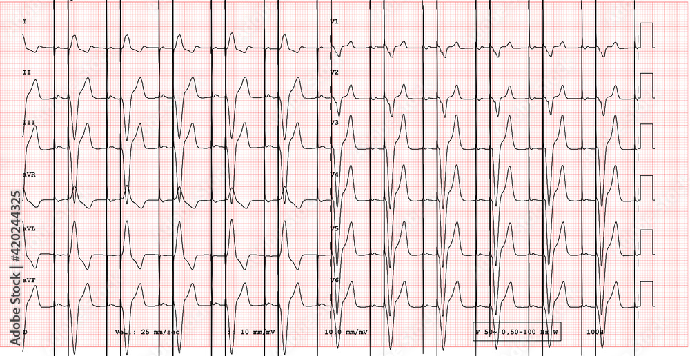 ECG example of a pacemaker 12-lead rhythm with pacing peak Stock ...