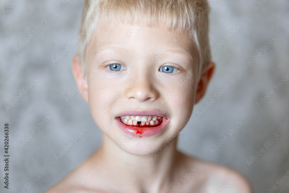 a 6-year-old blond boy with a broken tooth and blood, loss of teeth in ...