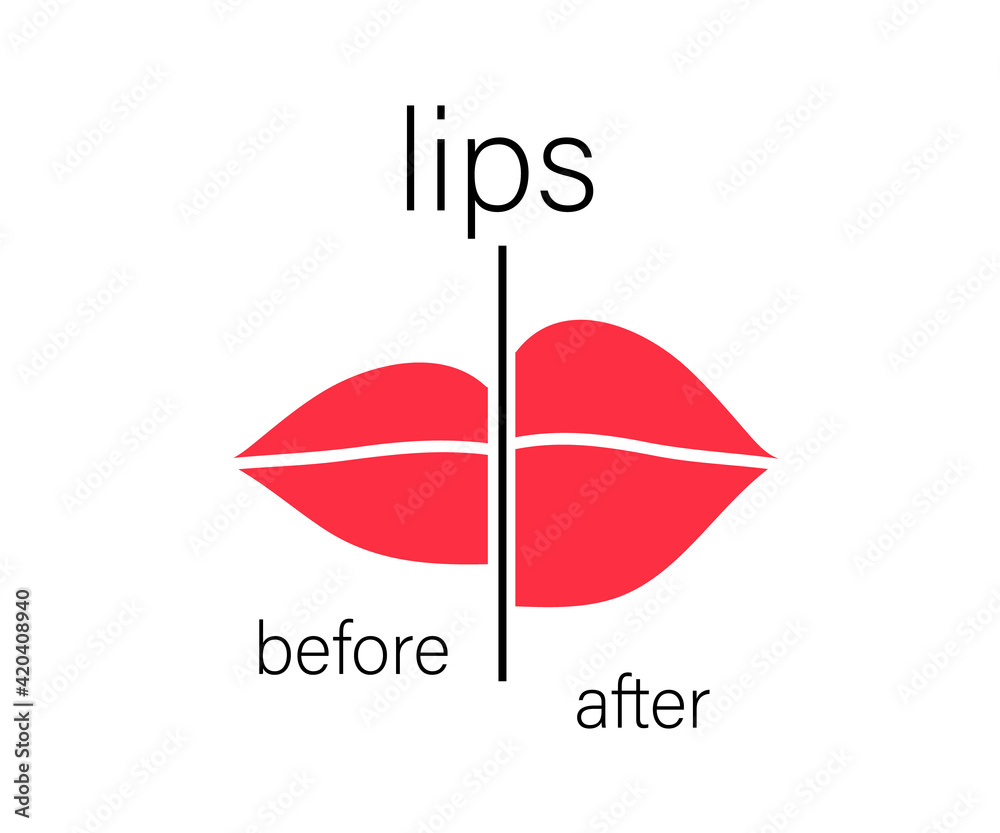 Lips before and after botox injection. Symbol. Vector illustration ...