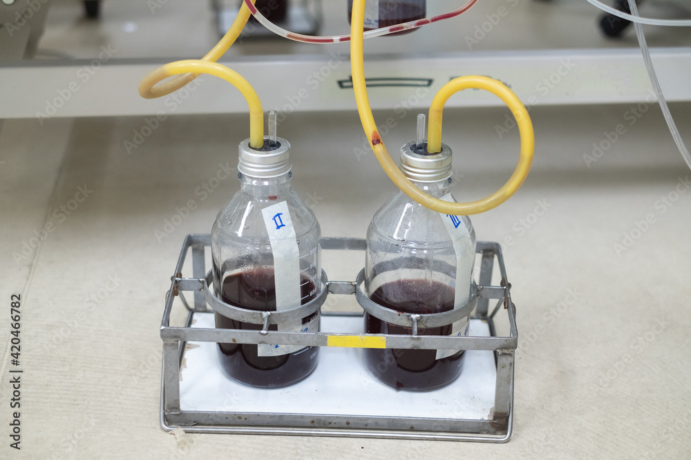 Two bottle system of chest drainage for patient post open heart surgery ...