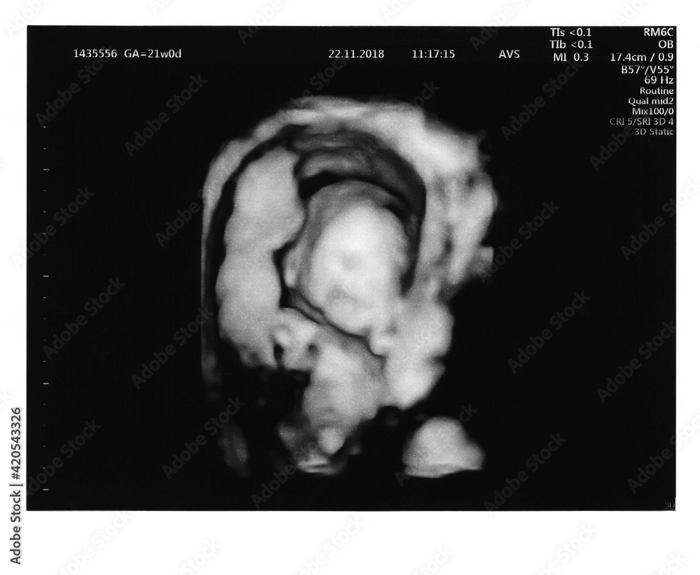 3d ultrasound picture of fetus Stock Photo | Adobe Stock