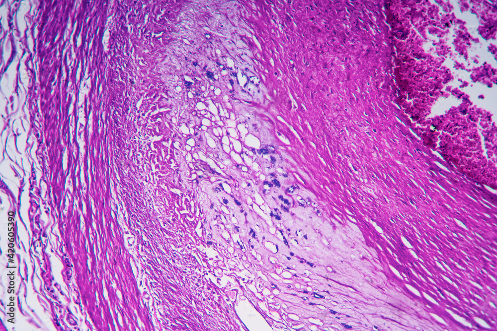 micrograph of human coronary artery atherosclerosis cells Stock Photo ...