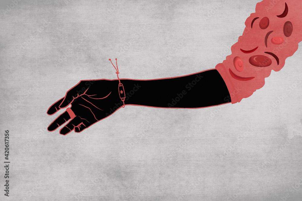 Sickle cell arm illustration Stock Illustration | Adobe Stock