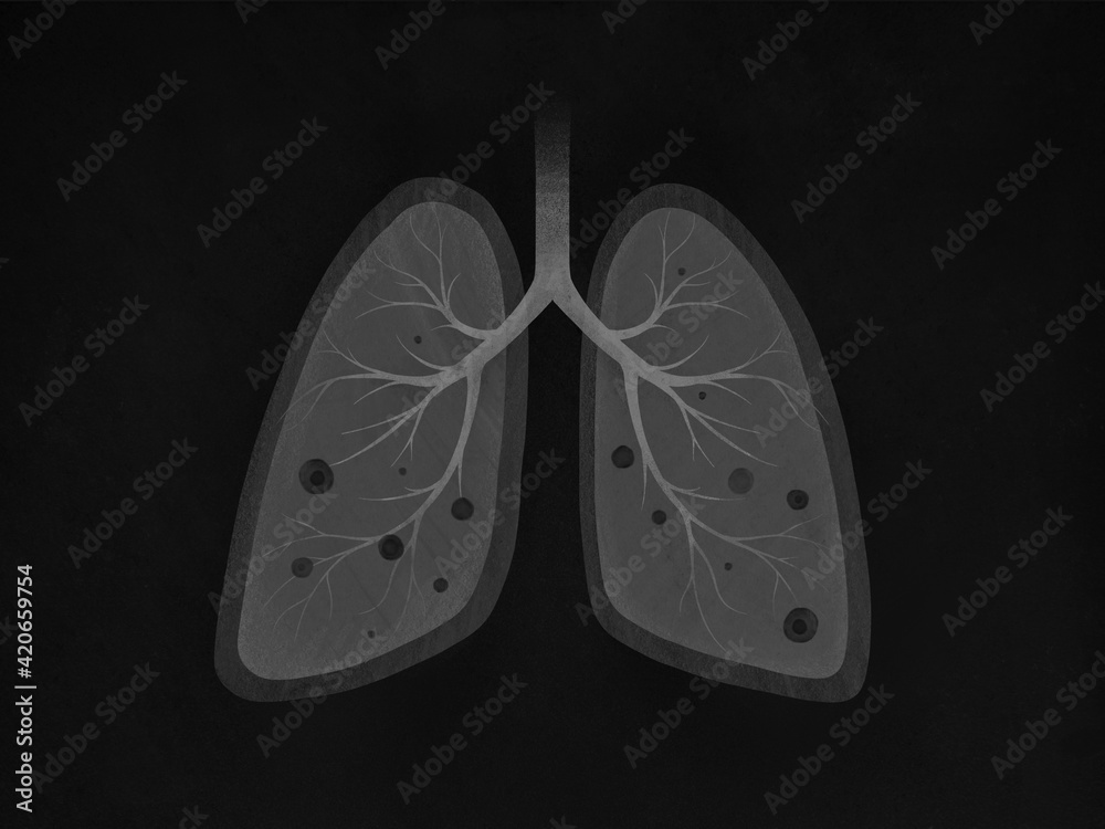 Lung Disease Pneumonia Asthma Cancer In The Form Of Lung Anatomy And