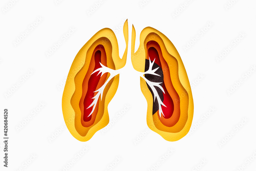 Papercraft structure of human lung with cancer. Stock Photo | Adobe Stock