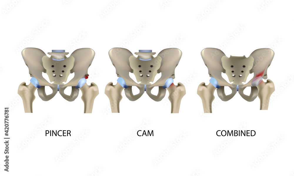 Femoroacetabular impingement, hip joint diseases, realistic medical ...