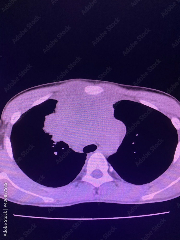 CT scan show heterogeneous mass at interior mediastinum , the mass ...