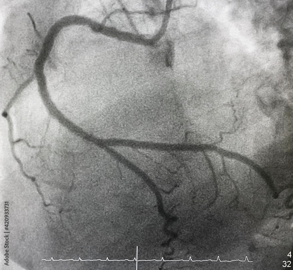 Normal coronary angiogram of right coronary artery (RCA) during cardiac ...