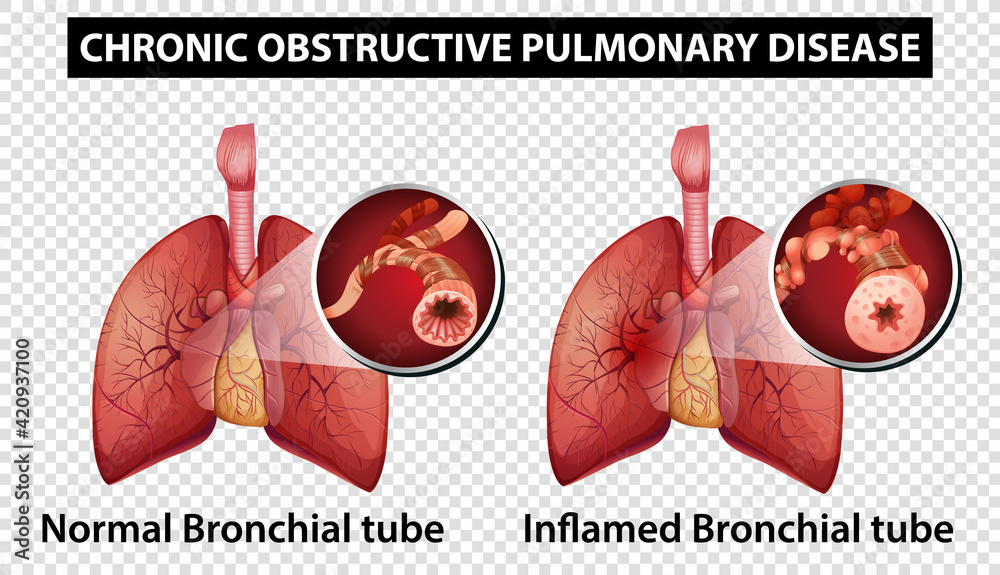 Diagram showing chronic obstructive pulmonary disease on transparent ...