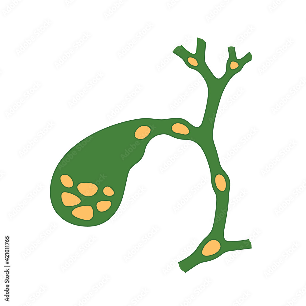 Variants of the location of stones in the gallbladder and bile ducts ...