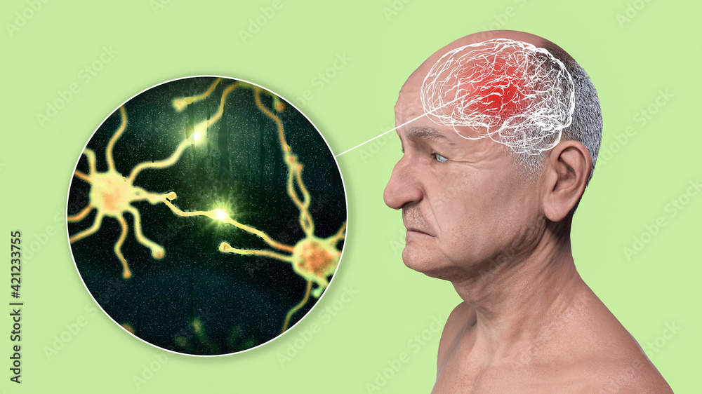 Dementia, conceptual illustration showing an elderly person with ...