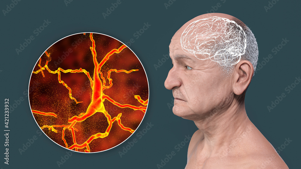 Dementia, conceptual illustration showing an elderly person with ...