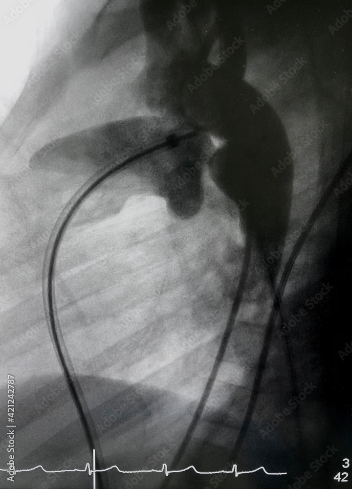 Aortography showed patent ductus arteriosus (PDA) during PDA closure ...