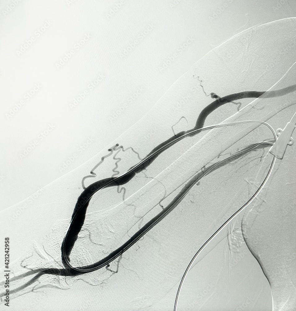 Angiogram of hemodialysis arteriovenous fistula (AVF) during ...