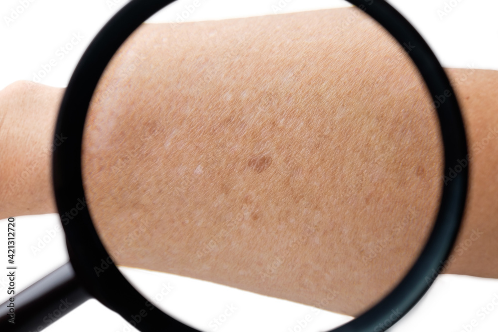 Magnifying glass on arm with Small white and brown spots on the skin of ...