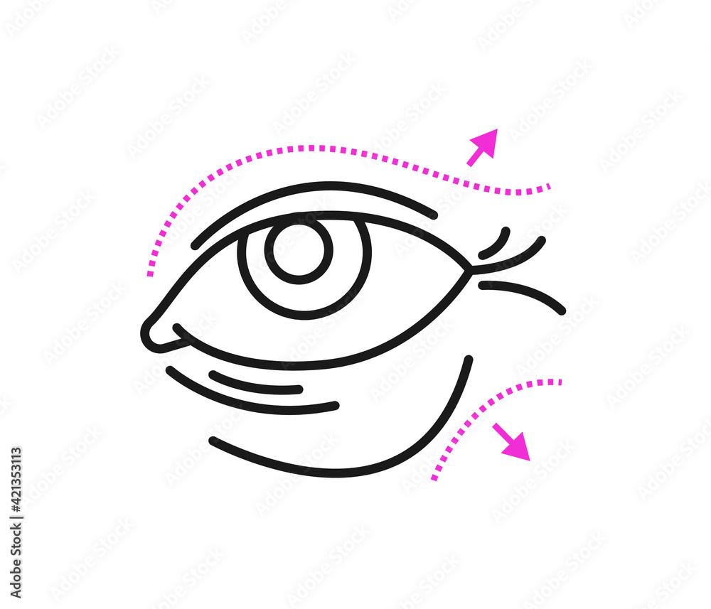 Upper eyelid reduction, eyelid lift plastic surgery concept. Wrinkles ...