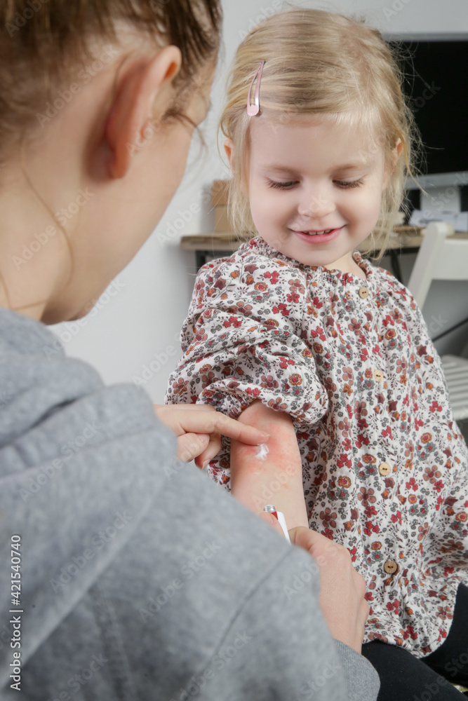 Mother applaying ointment onto red and itchy eczema on her daughter's ...