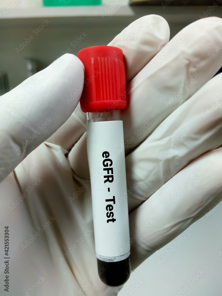 Blood sample for eGFR, Renal Function Test. GFR, Creatinine, Bun ...
