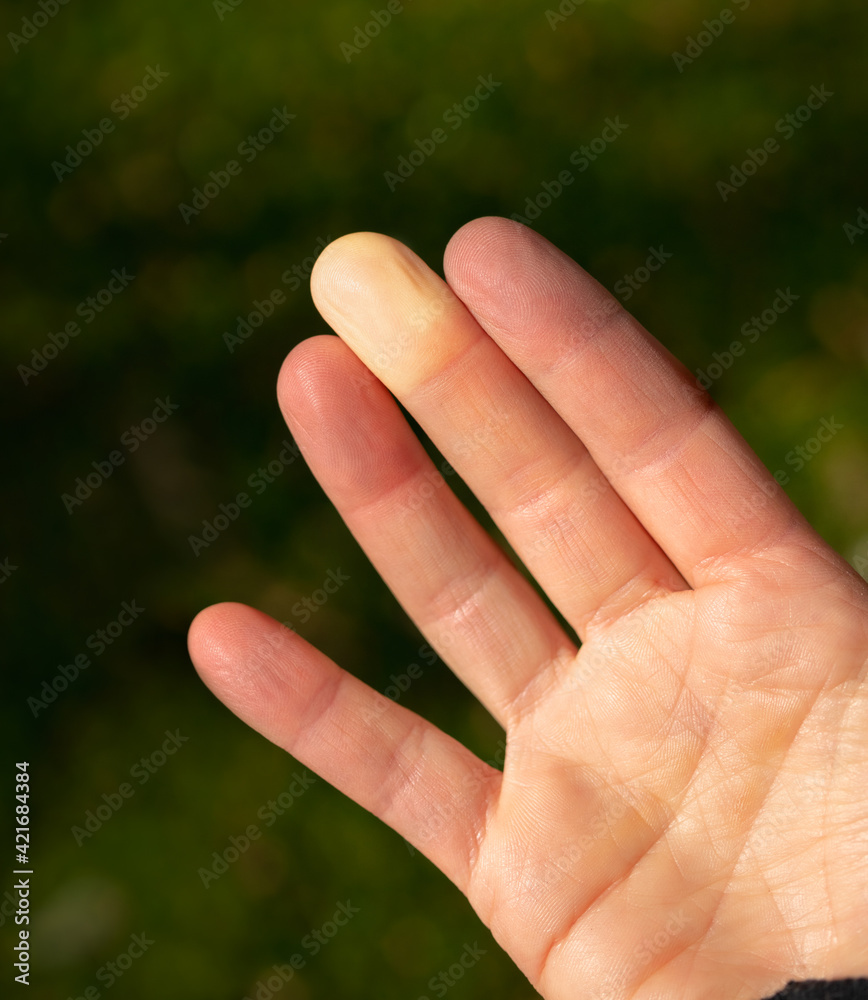 Fingers with Raynaud's syndrome or Raynauds diseases. Female hand. One ...