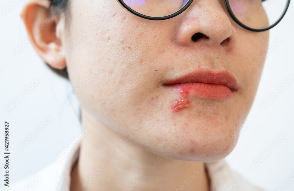 Herpes labialis of the woman lower lip. Blisters that break open and ...
