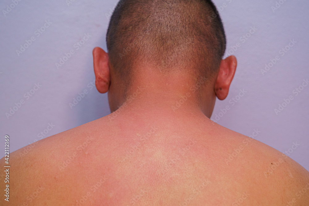 Man adult onset food allergy have had a severe reaction emergency care ...