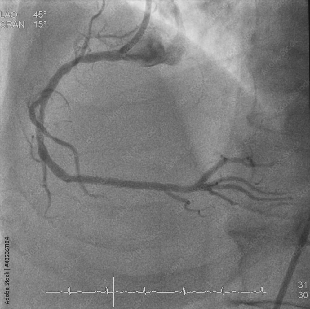 Coronary angiogram (CAG) was performed right coronary artery (RCA ...